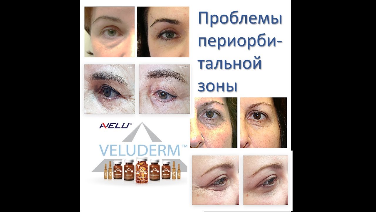 Проблемы периорбитальной зоны. Технологии Veluderm. - YouTube