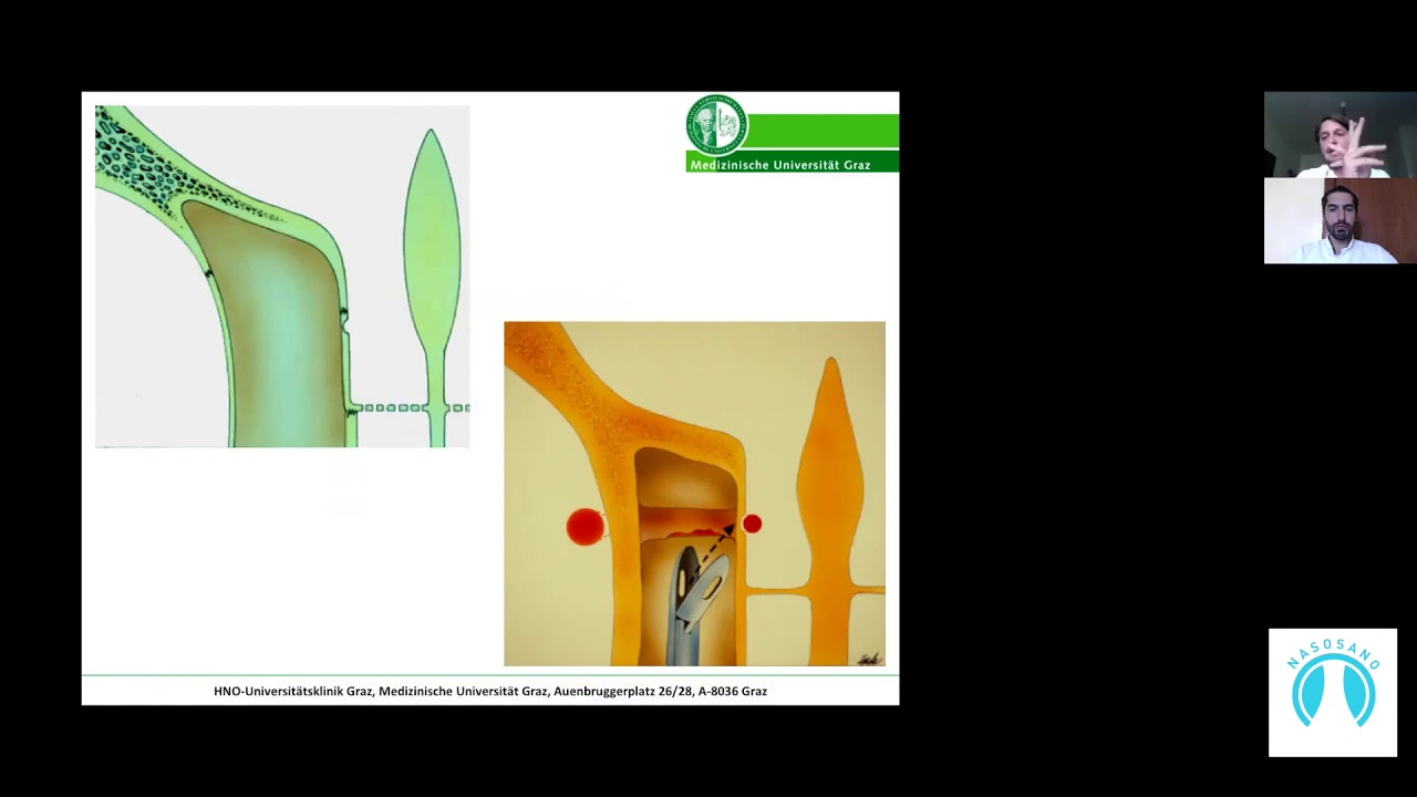 Endoscopic treatment of epistaxis - YouTube