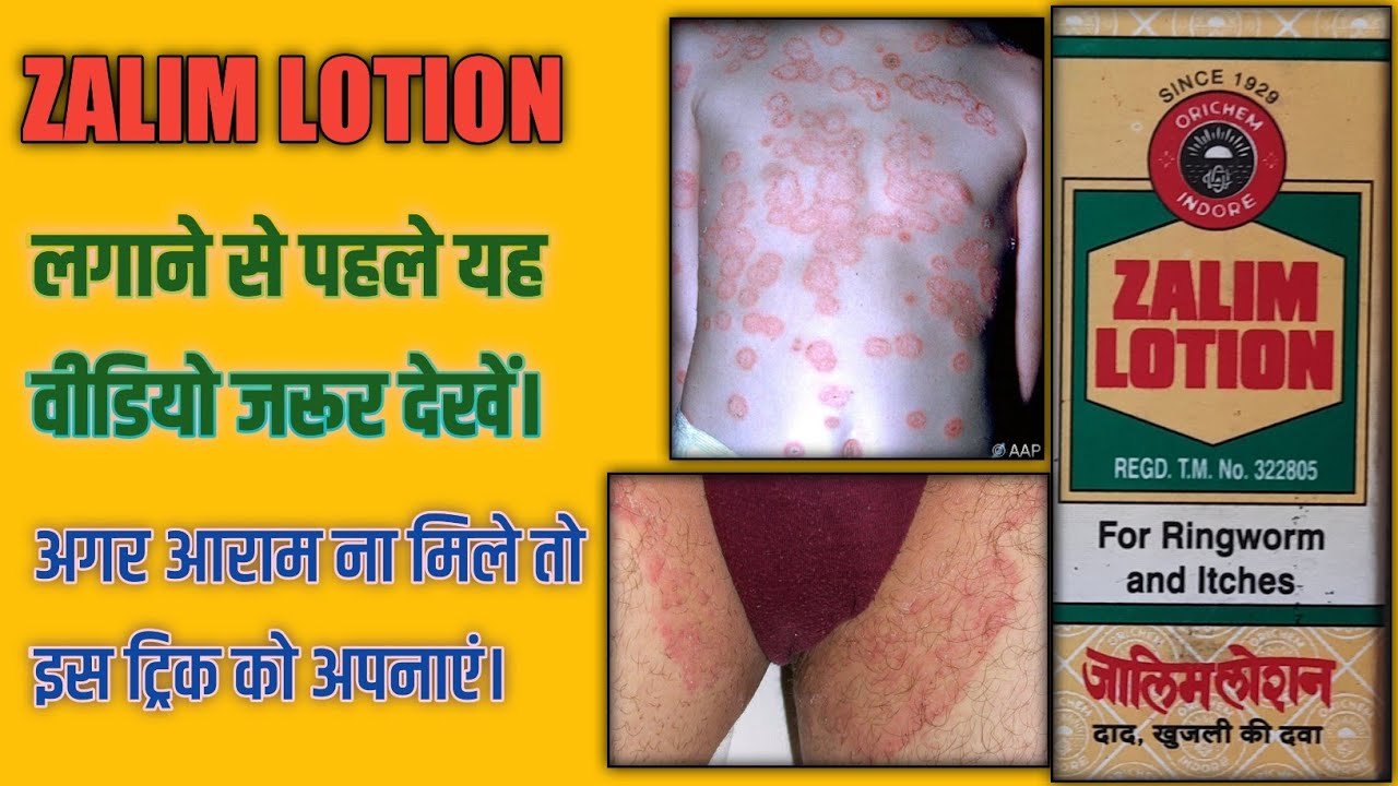 Zalim Lotion Uses, How to apply, Side-effects and reviews details in ...