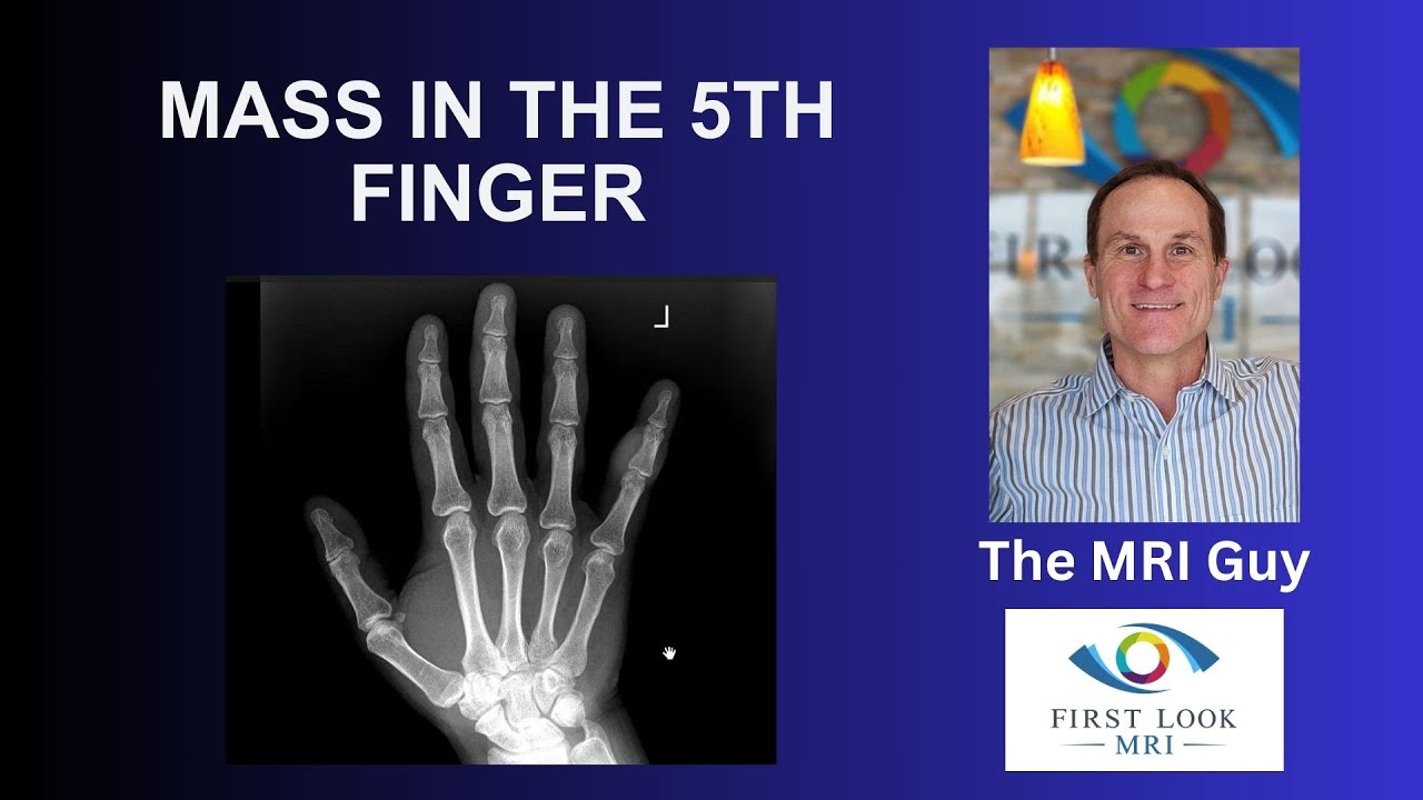 Mass in 5th finger - YouTube