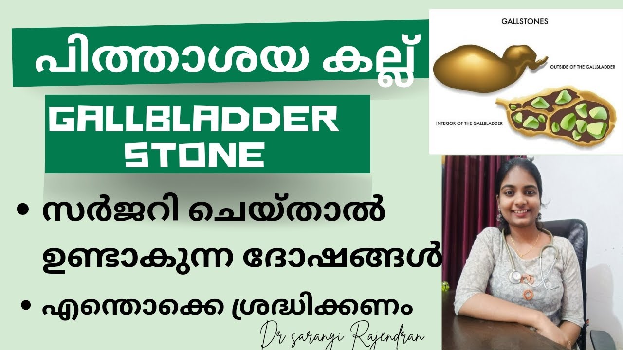 പിത്താശയ കല്ല്/gall bladder stone/സർജറി ചെയ്താൽ ഉണ്ടാകുന്ന ദോഷങ്ങൾ/Dr ...
