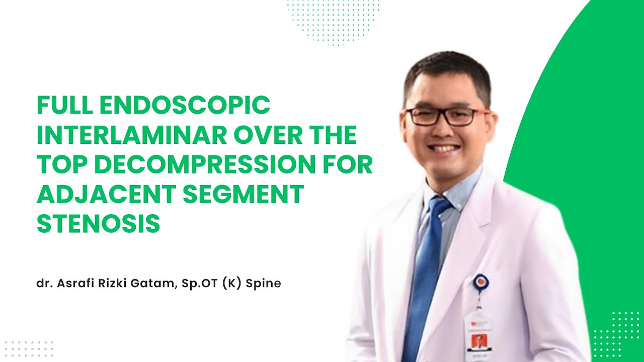Full endoscopic interlaminar over the top decompression for adjacent ...