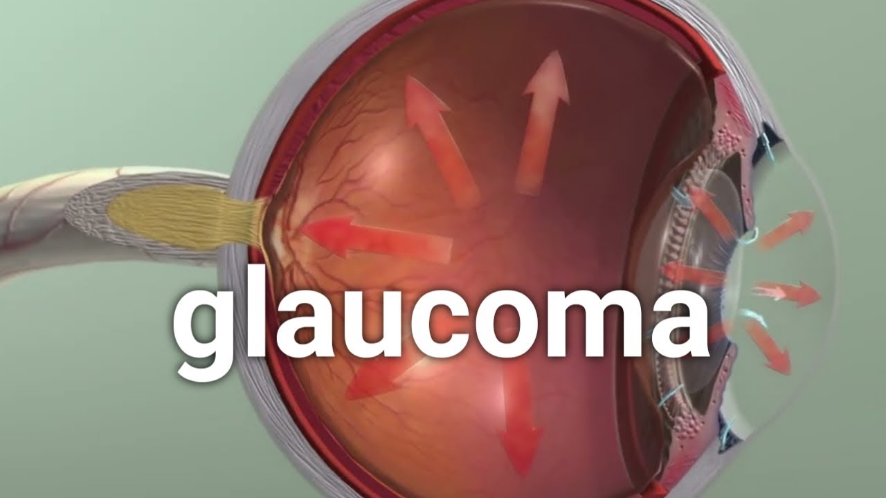 Glaucoma |what is glaucoma |Animation |Pharmacology lectures for ...