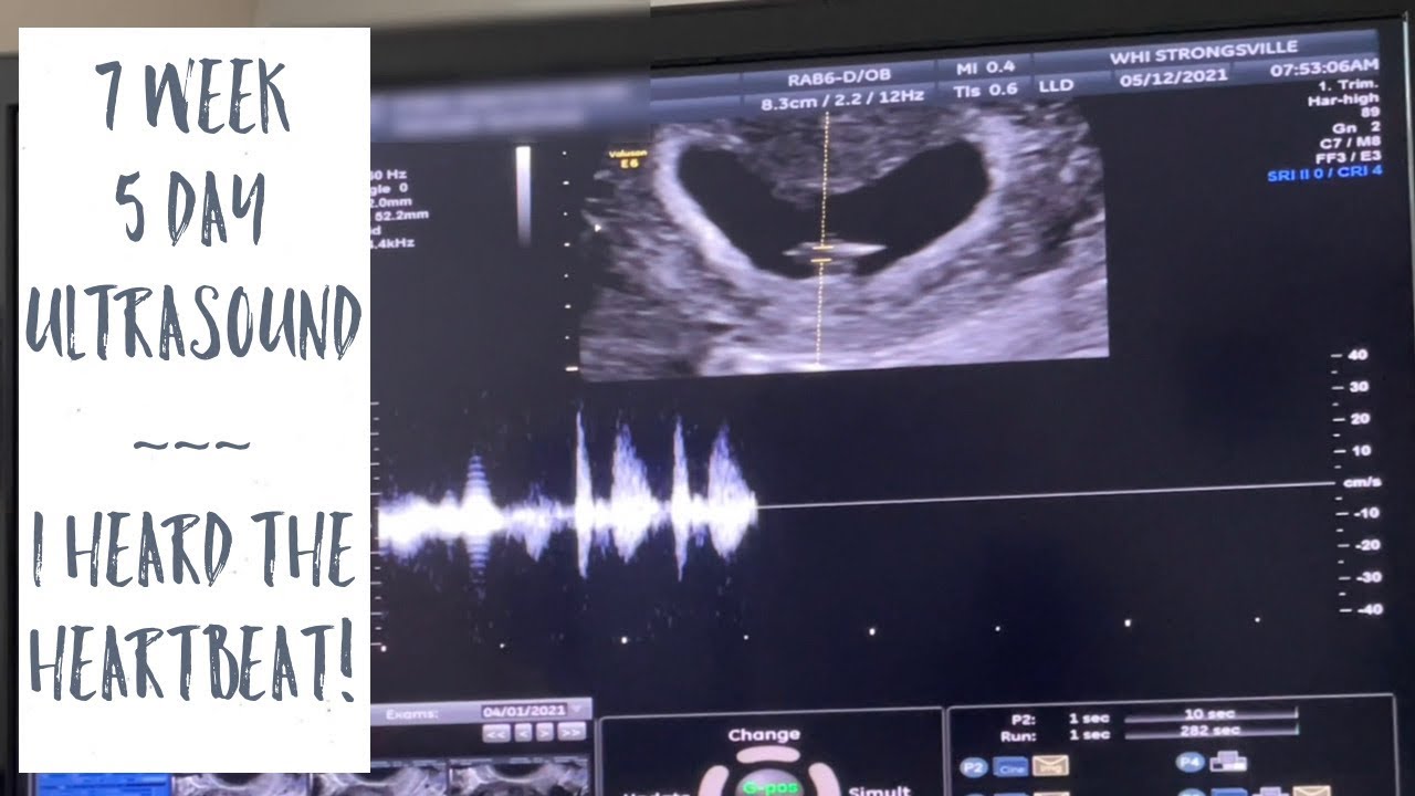 1st Baby | 3rd Ultrasound 7w5d | Hearing the Heartbeat for the First ...