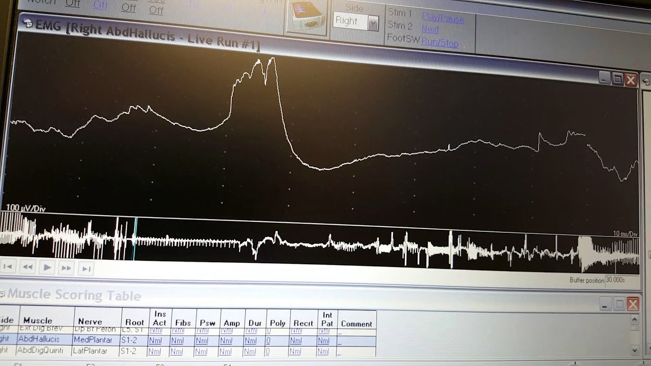 Complex repetitive discharges - YouTube