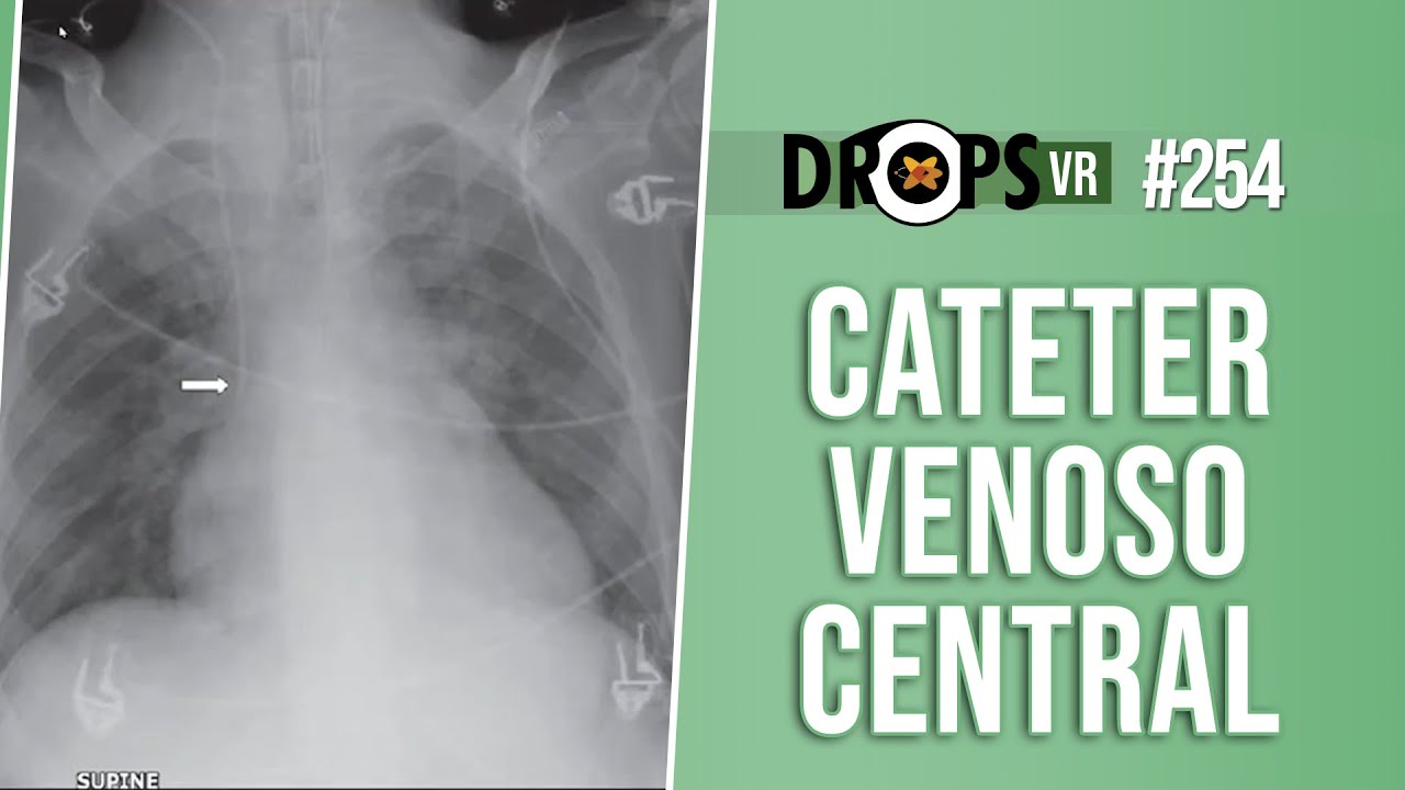 CATETER VENOSO CENTRAL - COMO VER NA RADIOGRAFIA? - YouTube