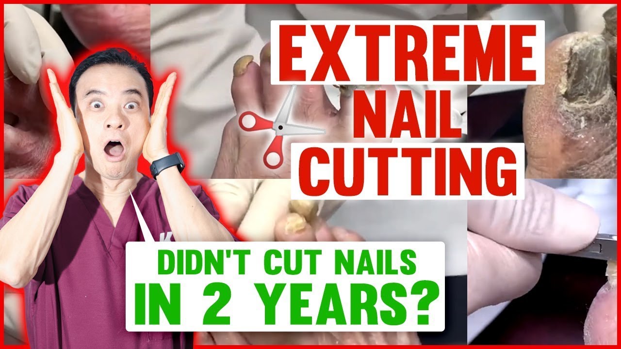 6 EXTREME nail cuts (2 years long nails, ram's horn fungal toenails and ...
