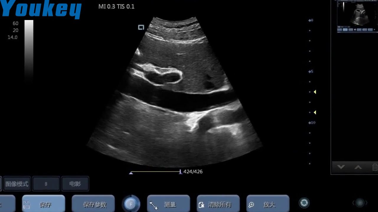 YOUKEY Wireless Ultrasound clinical images - YouTube