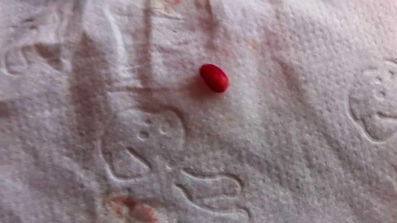 POLYP Self Removal DO NOT, DO THIS - YouTube