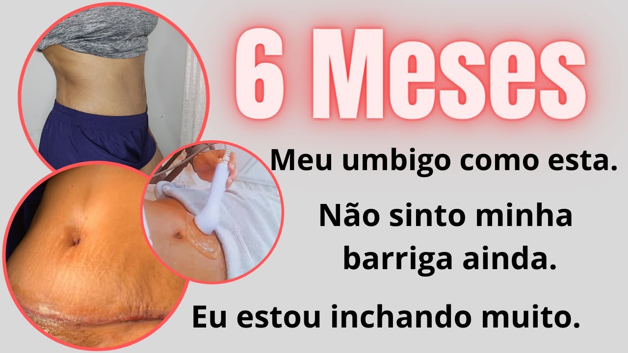 abdominoplastia PELO PLANO LIPO MOSTRANDO TUDO ,COMO FICOU A MINHA ...
