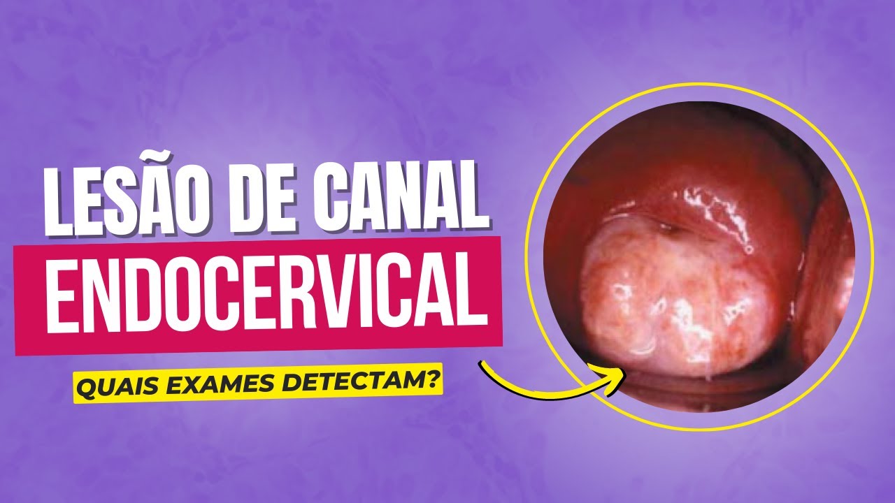 Quais Exames Detectam Lesão De Canal Endocervical Youtube