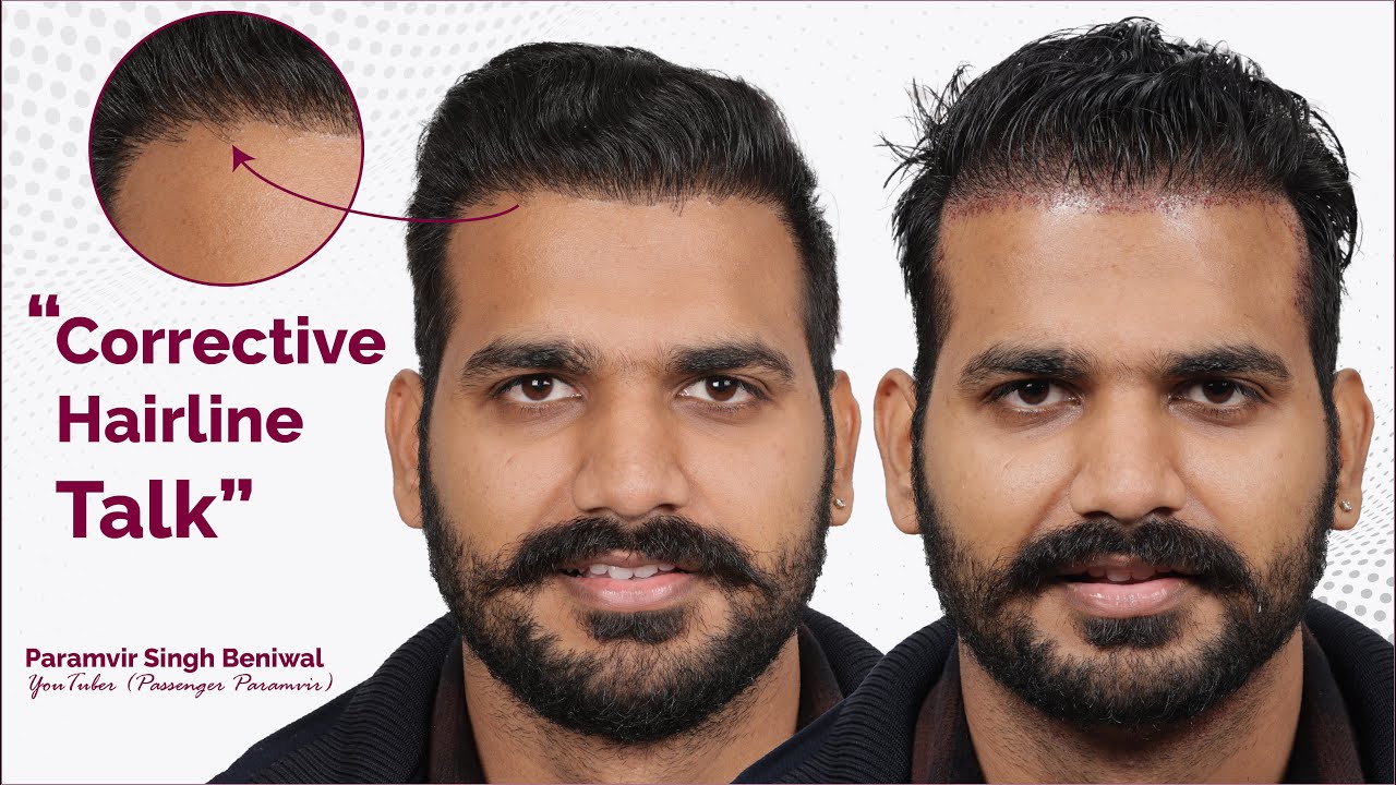 Master Class with Dr. Pradeep Sethi - Corrective Hair Transplant ...