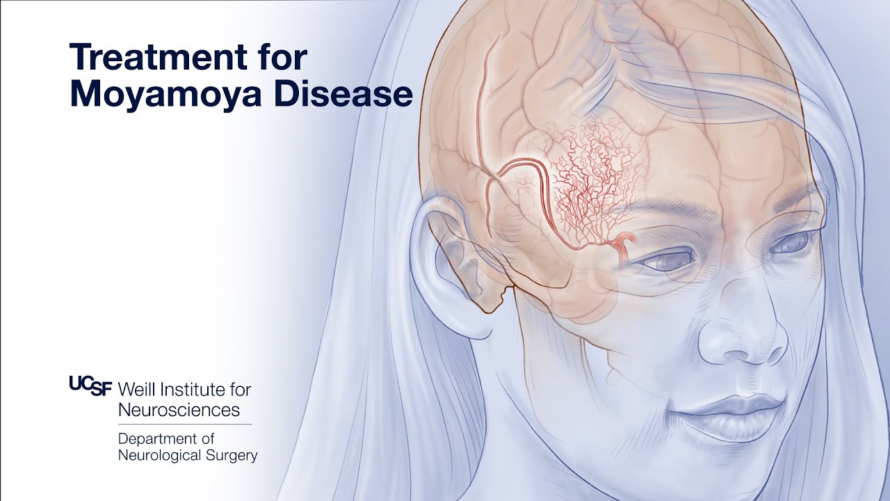 Treatment for Moyamoya Disease | UCSF Comprehensive Stroke Center - YouTube