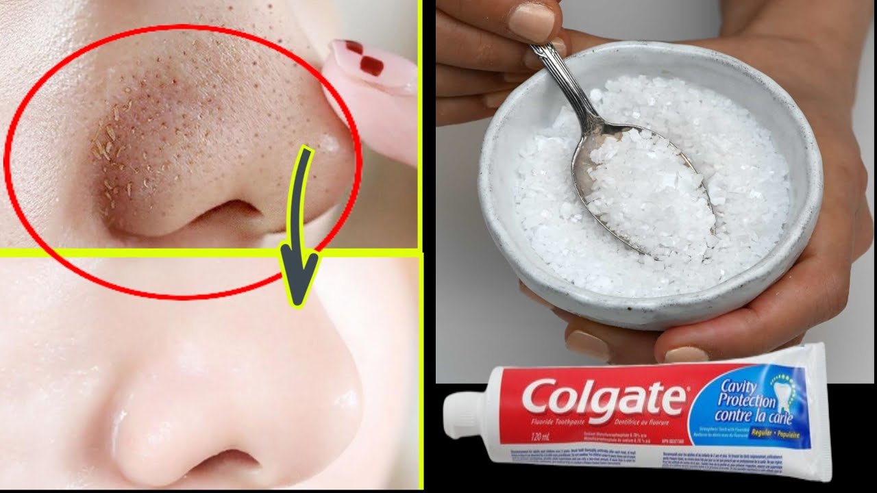 Just 5 Mints Best Way To Remove BLACKHEADS With Toothpaste How To just-5-mints-best-way-to-remove-blackheads-with-toothpaste-how-to