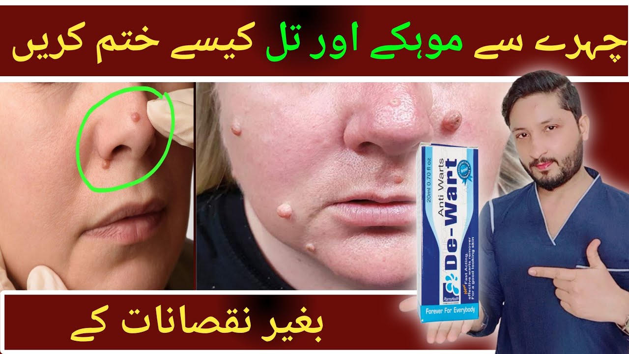 How to remove face warts | how to use de wart lotion | mole treatment ...