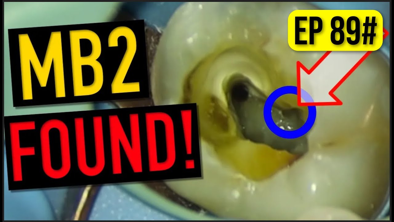 Stop Missing MB2: My Live Workflow on an Upper 6 - YouTube