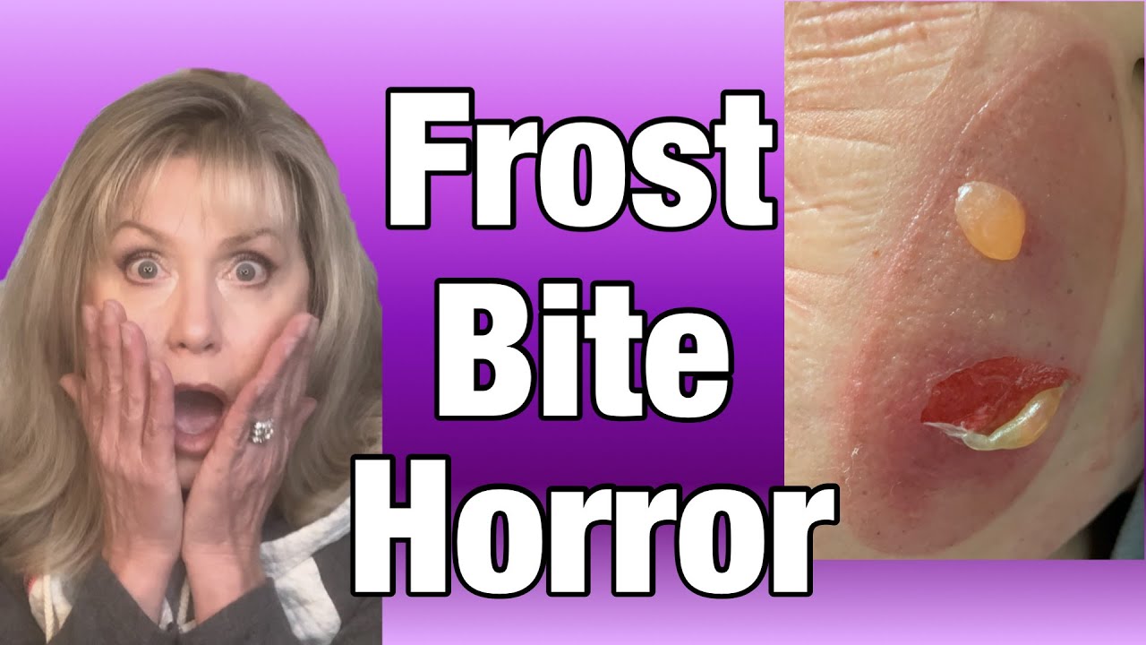FROSTBITE!! | How to avoid Frost Bite when doing DIY COOL SCULPTING | DIY Fat Freezing - YouTube