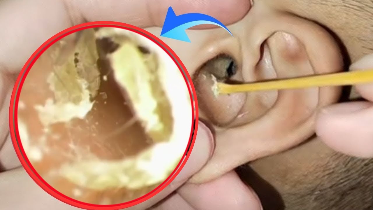WARNING: Deep, Infected Earwax Removal That Will Shock You | ASMR Ear ...