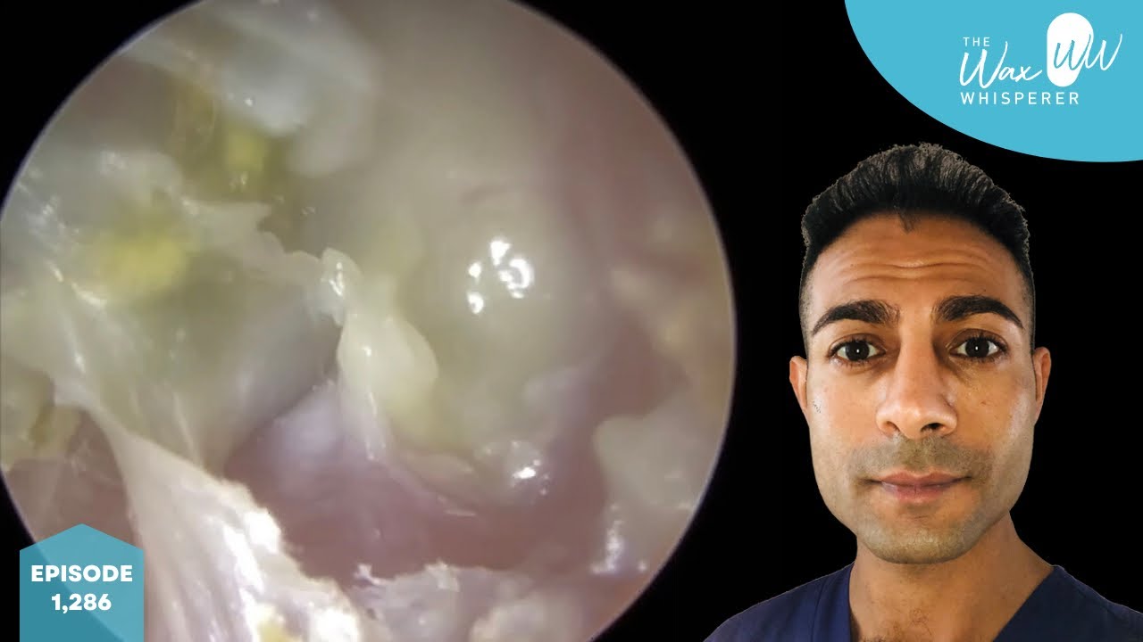 1,286 - Itchy Dead Skin Peel Hiding Ear Canal Pathology - YouTube