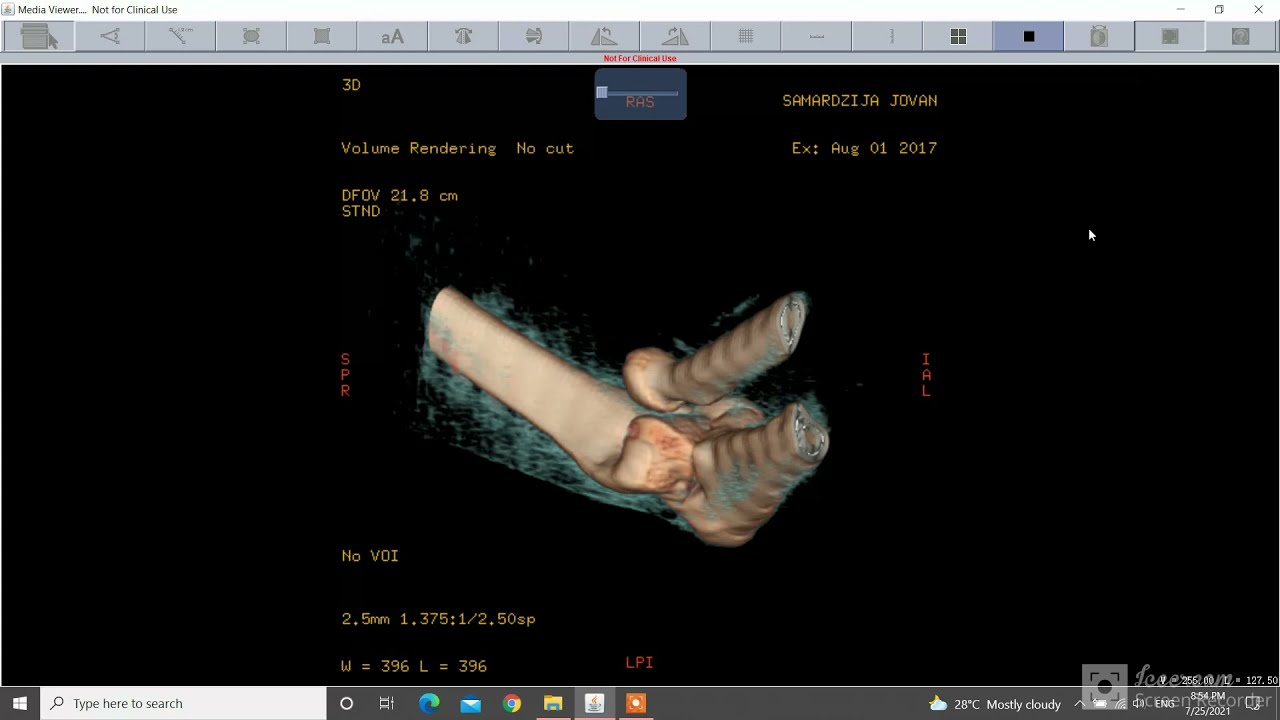 CT snimak desnog lakta - Right elbow CT - YouTube