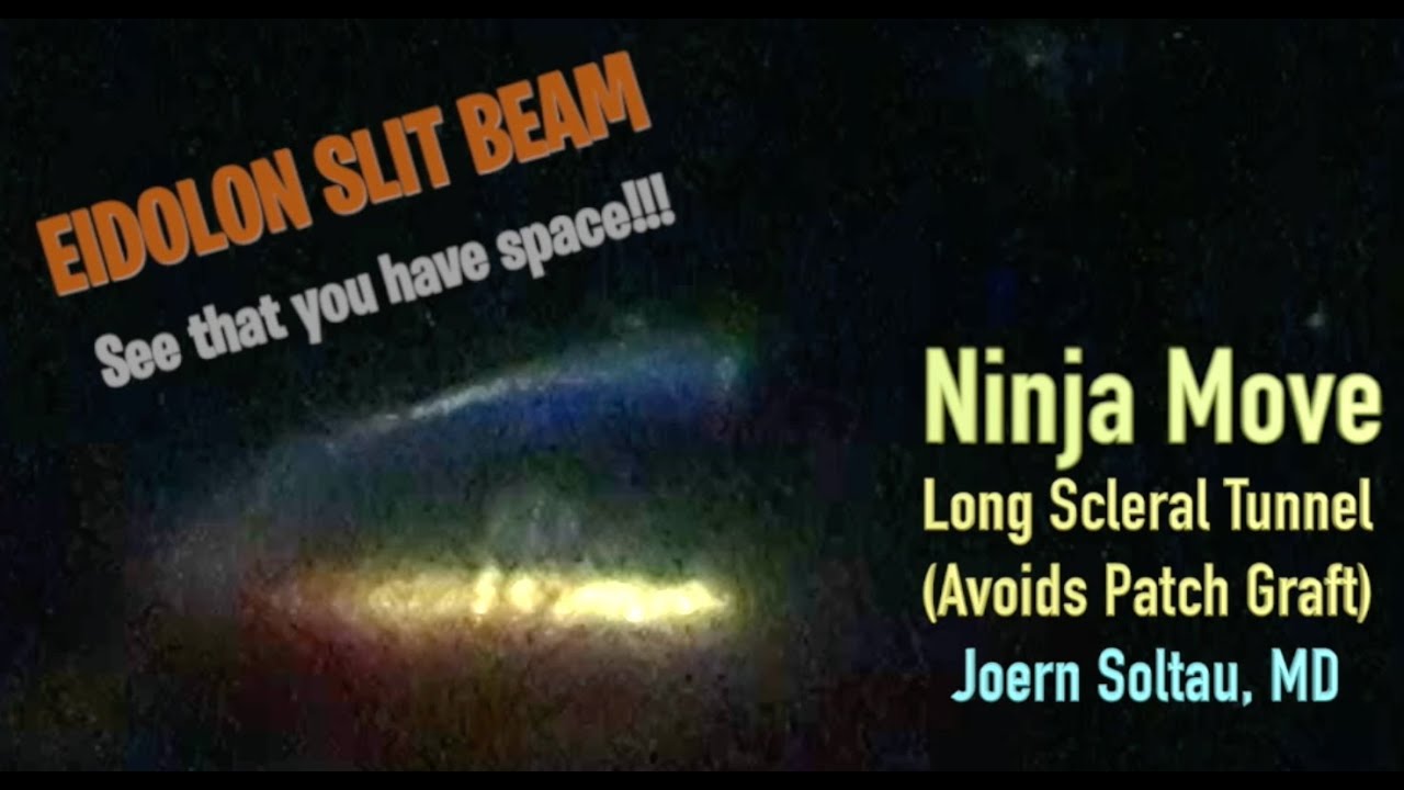 Glaucoma Tube Touching Endothelium & scar growing into Ahmed valve ...