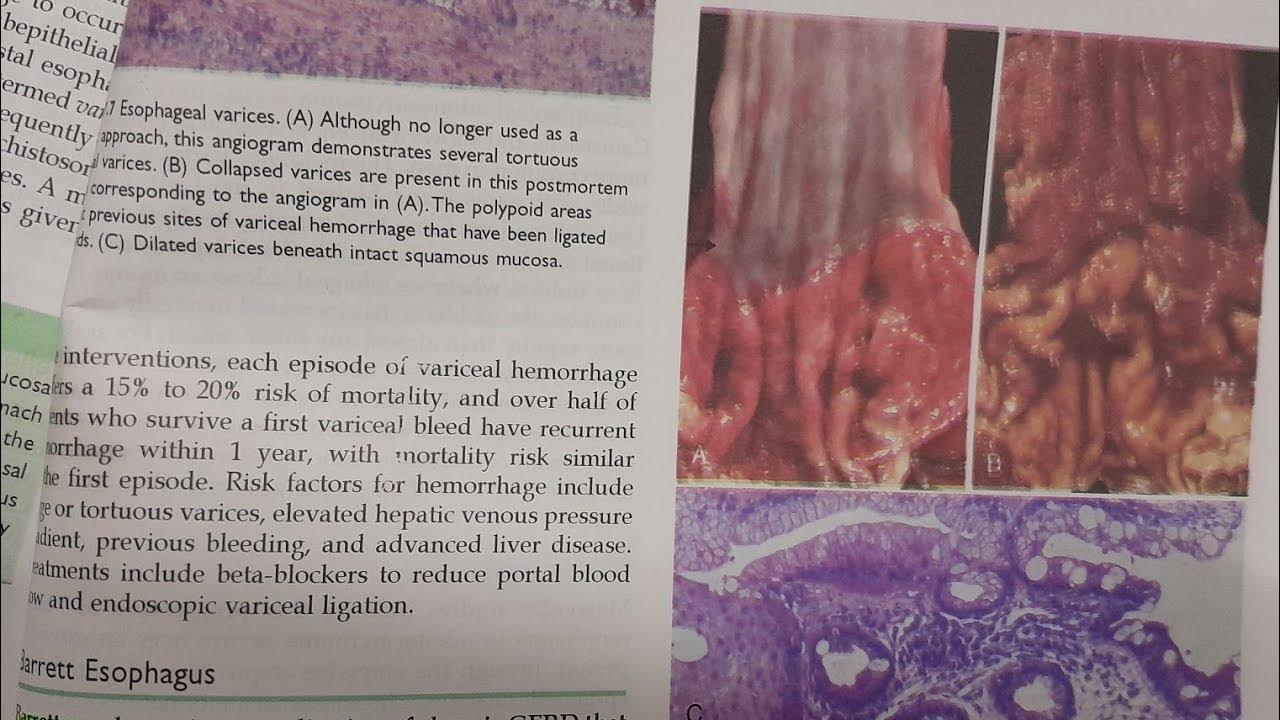 Barrett Esophagus - SPECIAL PATHOLOGY - YouTube