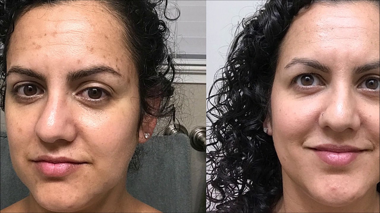 Meladerm Before and After Pictures (Amazing Results) - YouTube