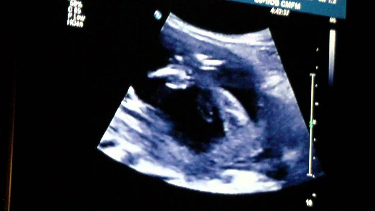 10-29-10 video 4 of 11 -- baby's humerus.MOV - YouTube