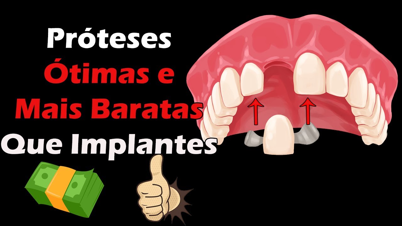 Prótese Fixa e Adesiva - Ótimas Opções Para Substituir Dentes Perdidos ...