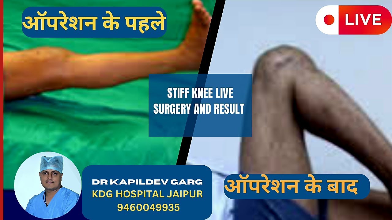 STIFF KNEE LIVE SURGERY AND Result Dr. Kapil Dev Garg | ghutna jaam ho jaye to kya karen # ...