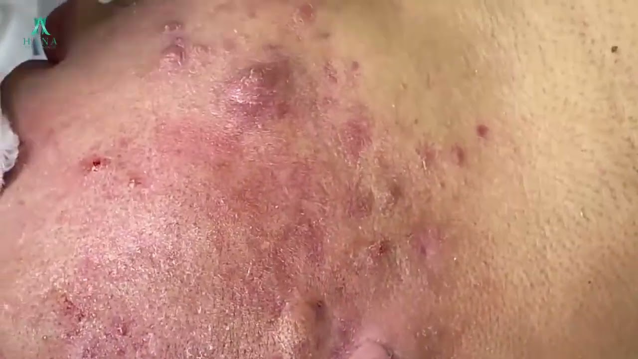 Big Cystic Acne Blackheads Extraction Blackheads And Milia Whiteheads
