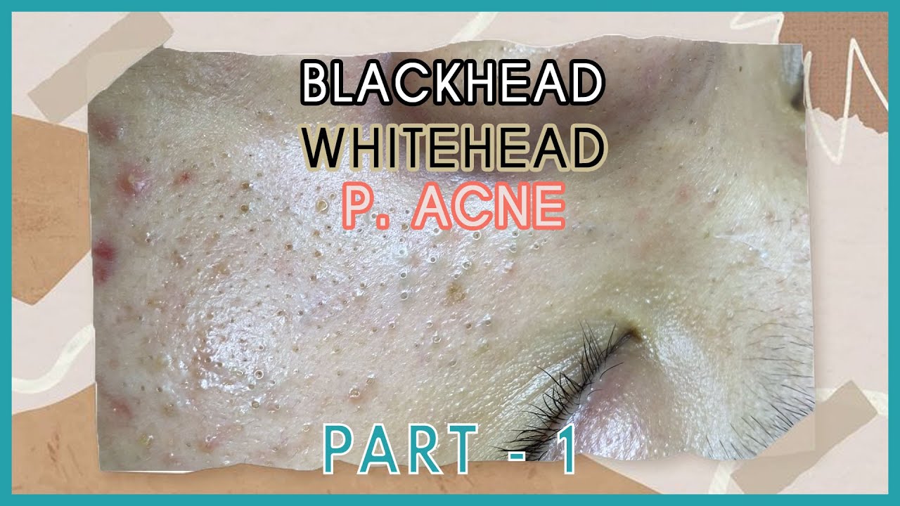 Big Cystic Acne Blackheads Extraction Blackheads & Milia, Whiteheads ...