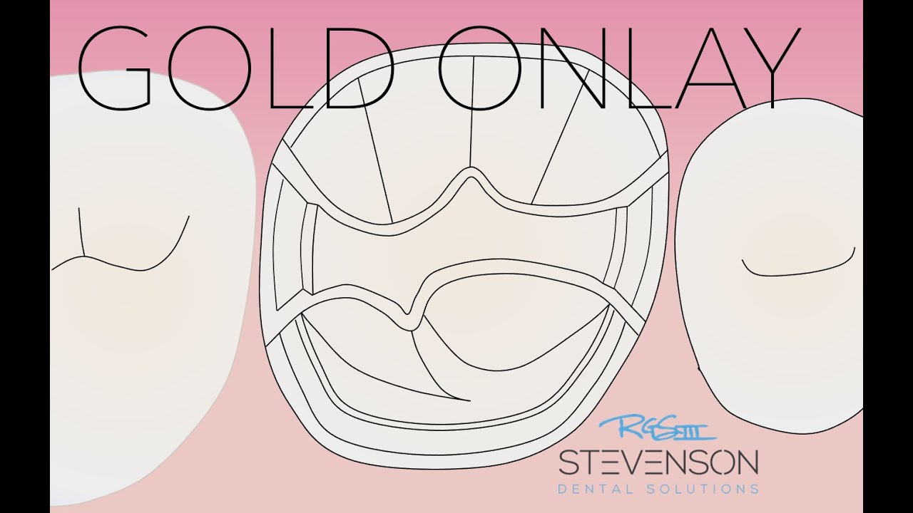 MOD Gold Onlay Preparation on Typodont #3 Kilgore - YouTube