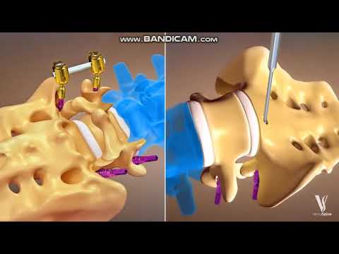 Spinal cord Surgery Animated Video || Naya Pusta|| - YouTube