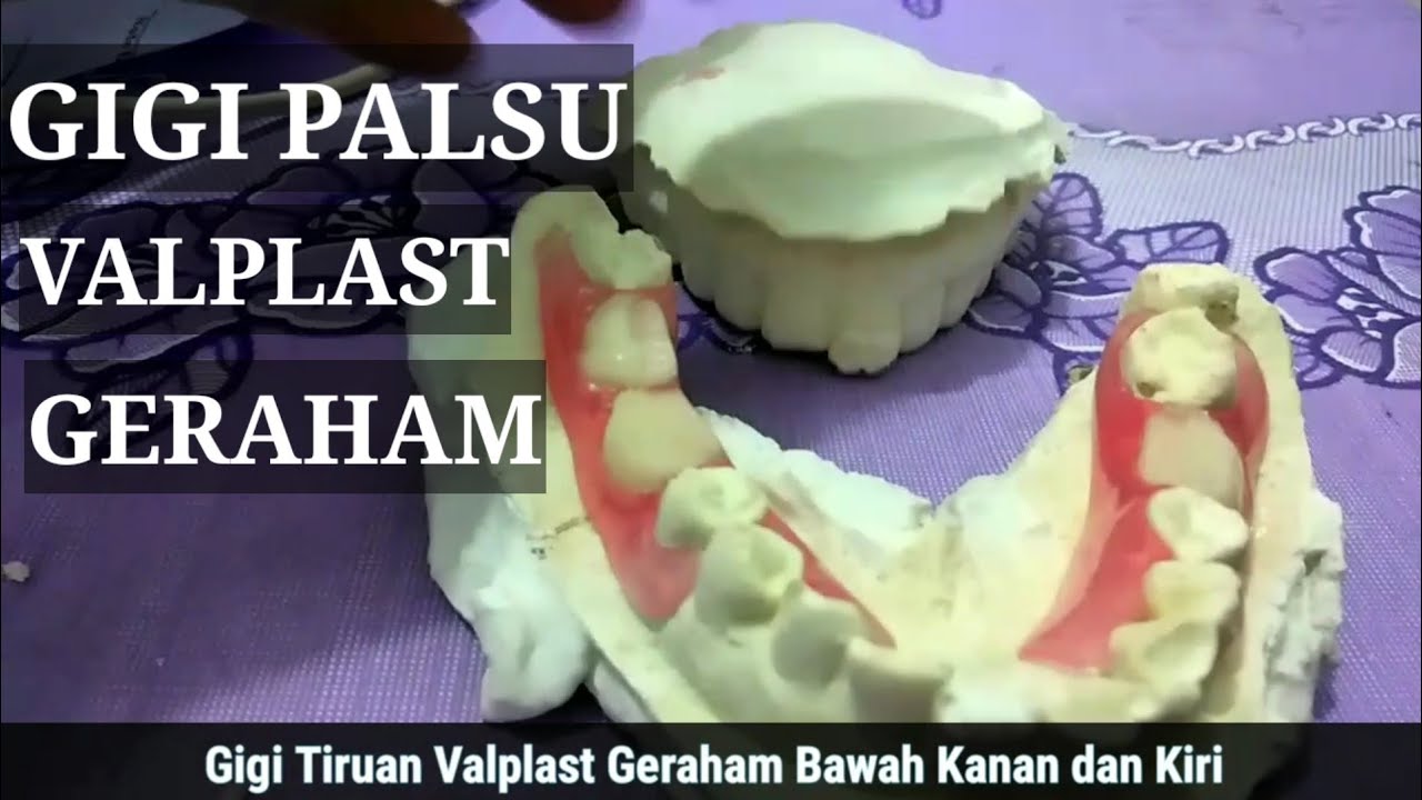 GIGI PALSU VALPLAST GIGI GERAHAM BAWAH - YouTube