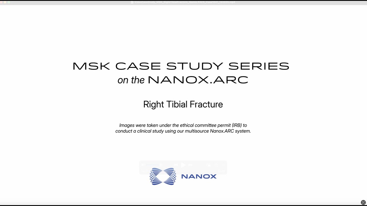 Clinical Case Study | Right Tibial Fracture | Nanox Vision - YouTube
