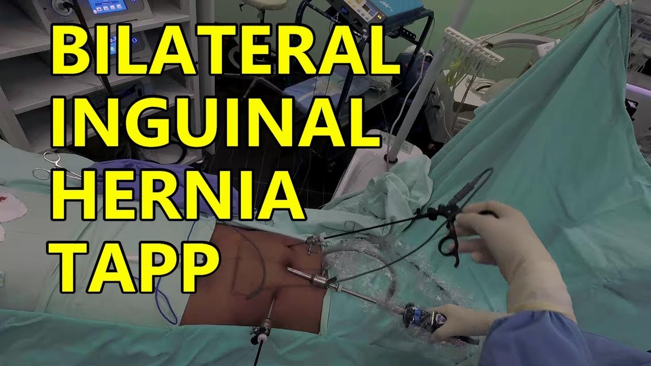 Bilateral Inguinal Hernia Repair With Sound And Subtitles TAPP No