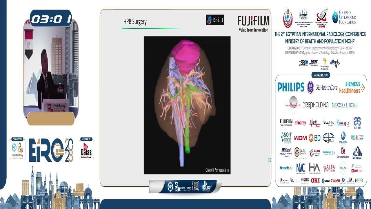 Fujifilm Advances Visualization Post-Processing as Surgical Planning Tool Al: Synapse-3D - YouTube