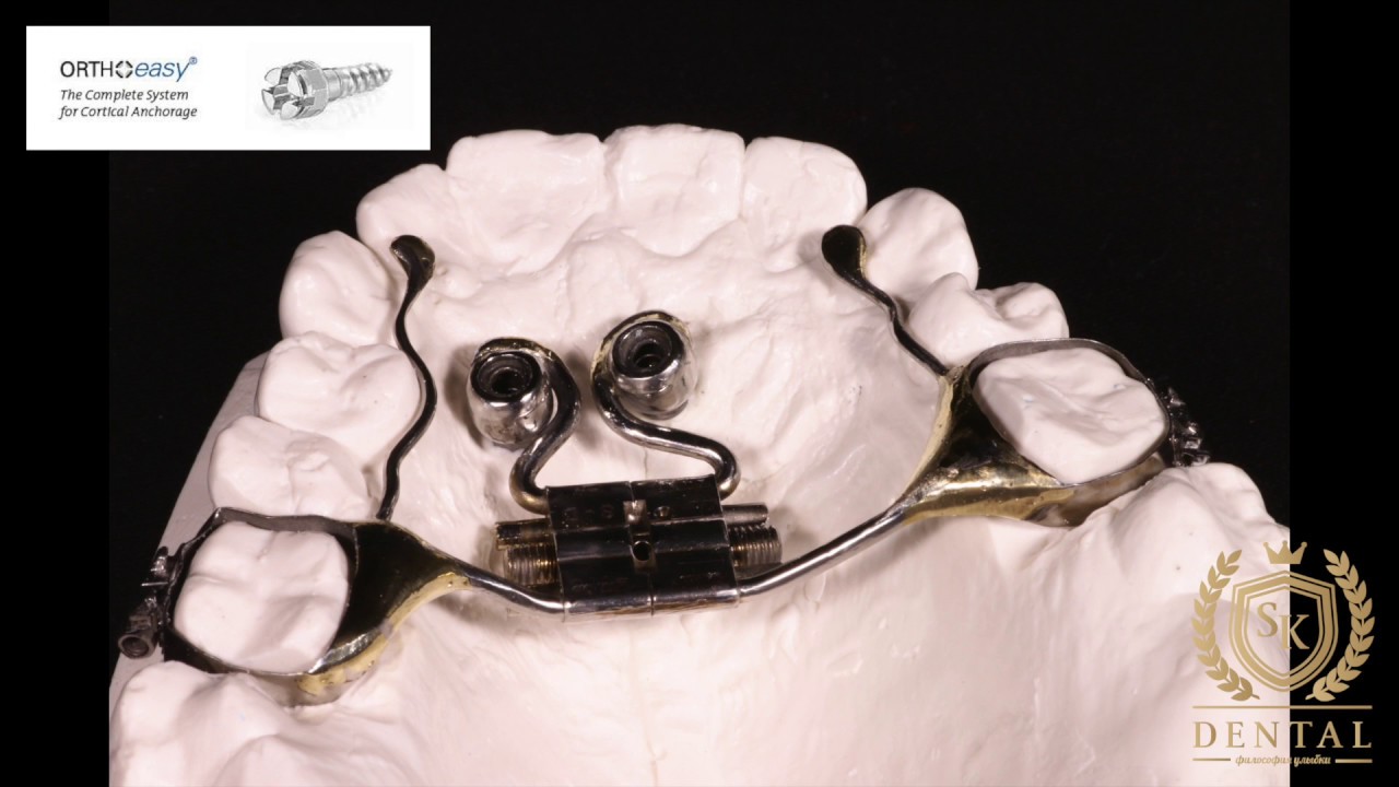 TAD anchored palatal expansion appliance by Dr.Svitlana Koval, MSc ...