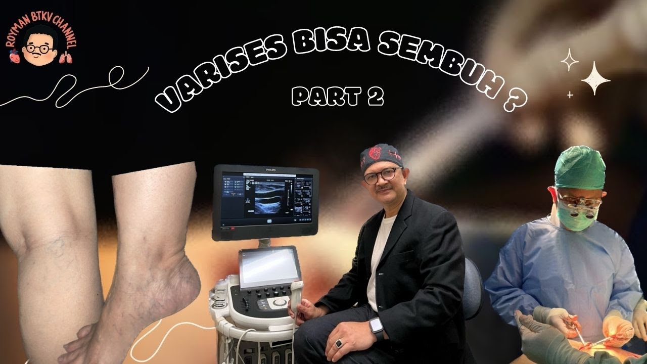 VARISES BISA SEMBUH? GIMANA CARANYA? PART 2 - YouTube