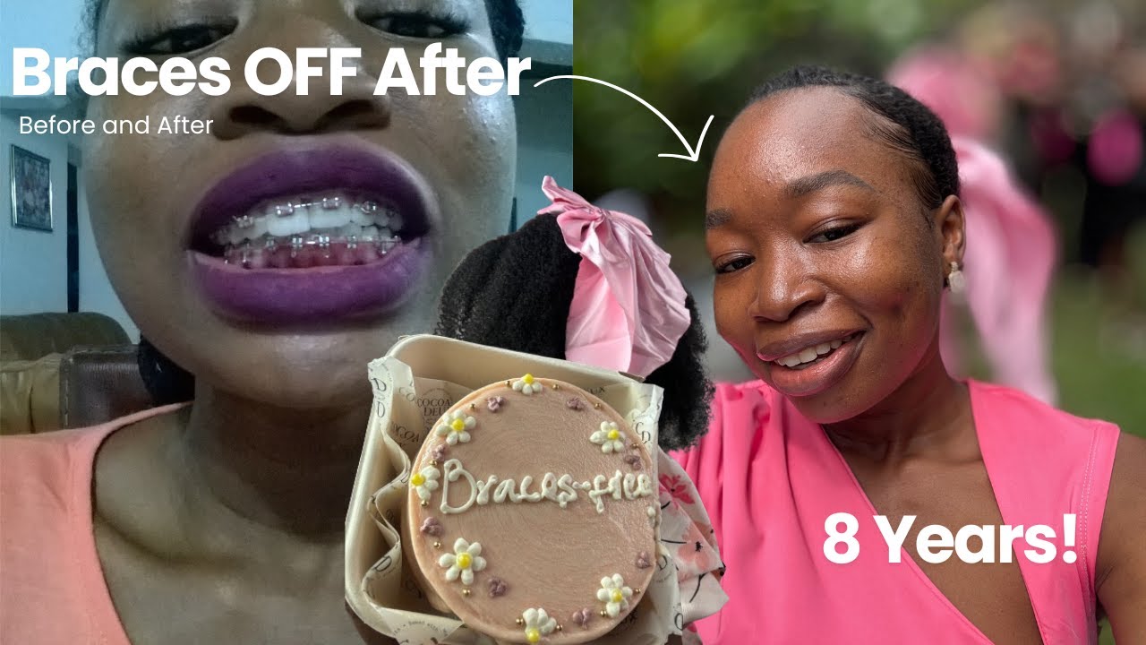 After 8 Long Years… My Braces Are Finally Coming Off! 🥳 | Braces ...
