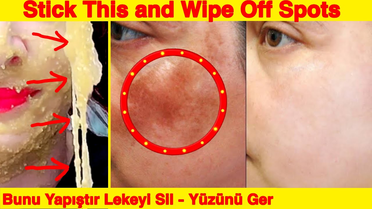 Stick This onto Spots and Wipe Them Off ! Non-Surgical Face Lift - Spot ...