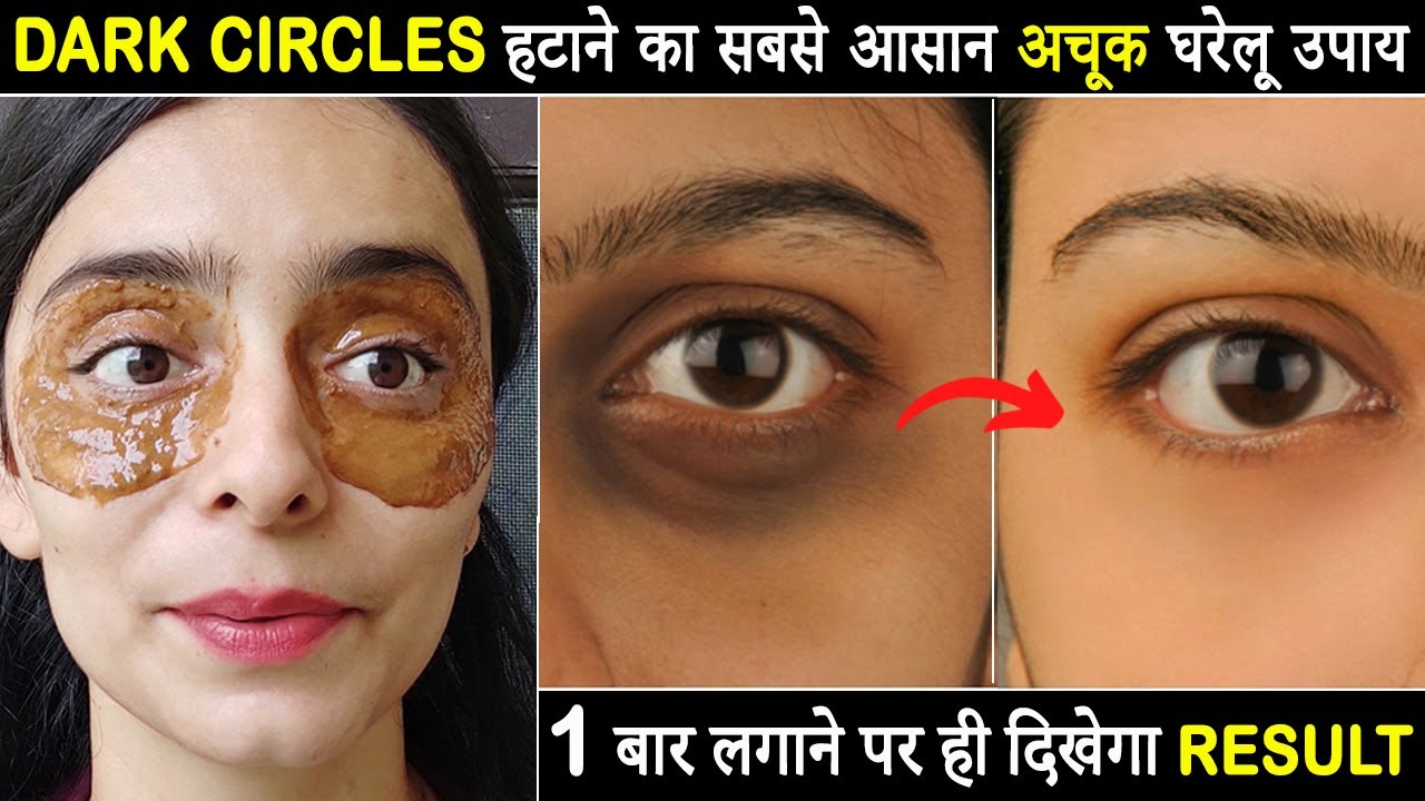 Remove Dark Circles in 7 Days Challenge | Dark Circles Kaise Hataye |How to Remove Dark Circles ...
