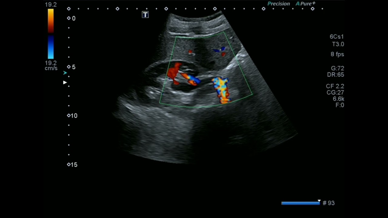 Ultrasound video showing twinkle artifact - YouTube