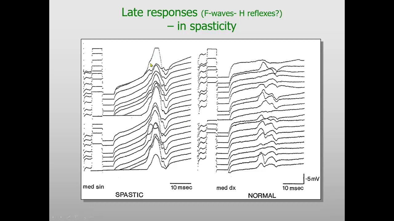 F-Wave, A-Reflex and H-Reflex Lecure - YouTube