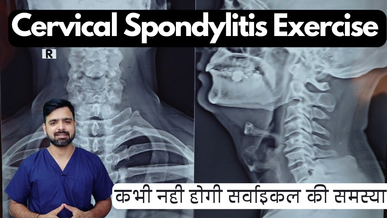Exercises for cervical spondylitis | Cervical spondylosis exercise in ...