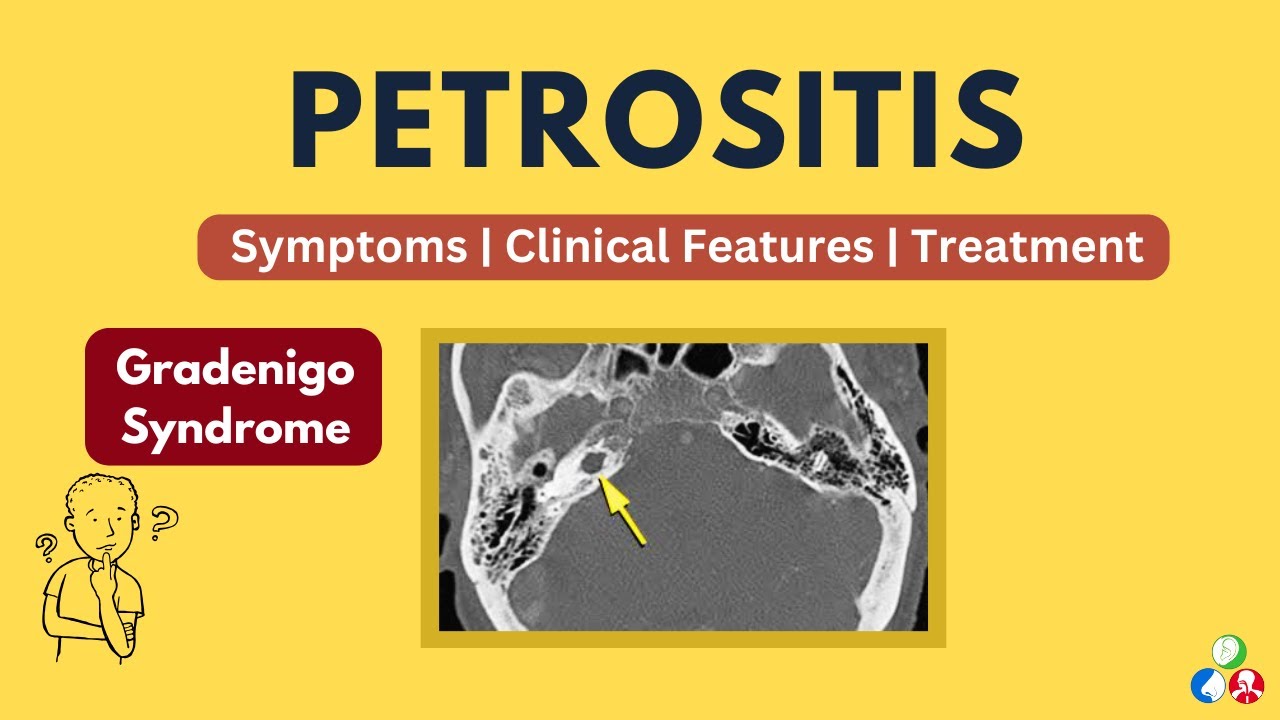 Petrositis | Symptoms, Treatment - YouTube