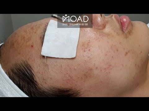 남자 좁쌀여드름, 색소침착, 흉터 관리 후기 (Review of millet acne, pigmentation, scar ...