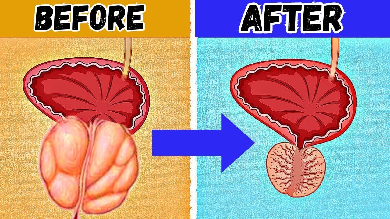 7 Proven Ways to Say Goodbye to Enlarged Prostate - YouTube