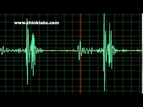 Right Bundle Branch Block- normal speed